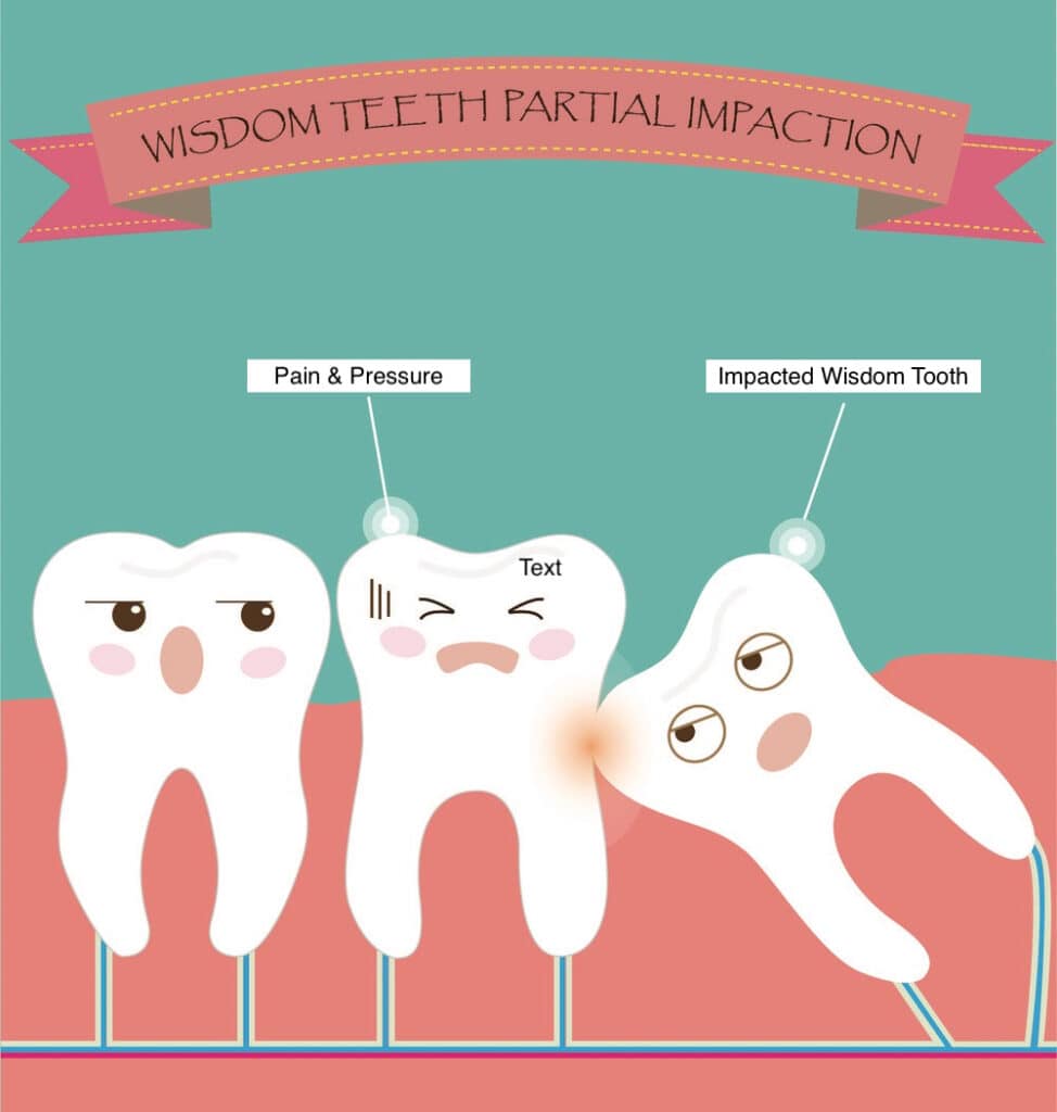 Wisdom Teeth Removal | Pain Relief | Dr Alps Thakkar
